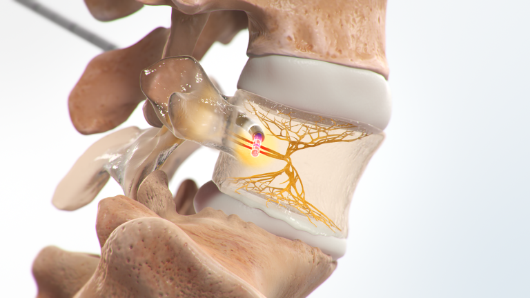 Intracept Procedure - Indiana Spine Group